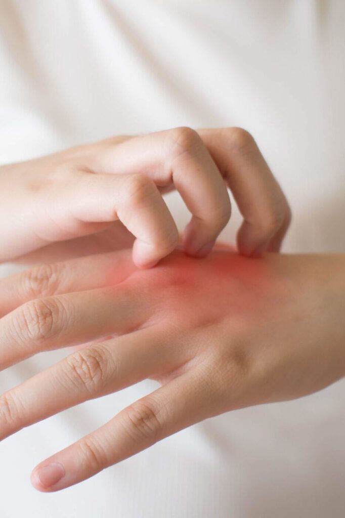 DERMATITE DE CONTATO - Host Clínica