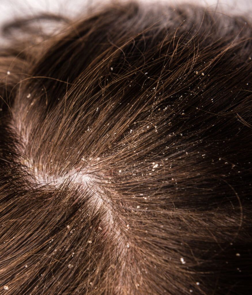 DERMATITE SEBORREICA - Host Clínica